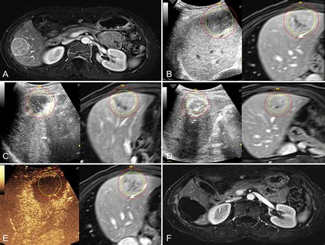 Microwave Ablation Assisted By Ultrasound Fusion Imaging Jhc