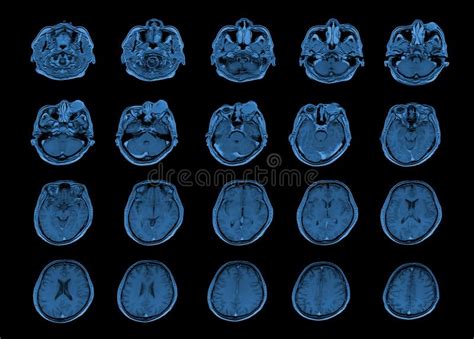 Mri Of Brain And Orbit Finding A Well Defined Cystic Lesion With