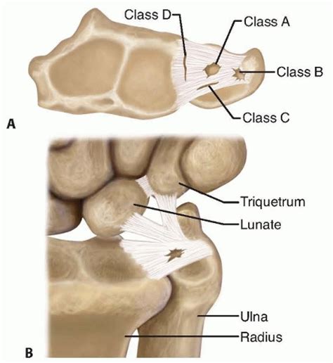 Arthroscopic And Open Triangular Fibrocartilage Complex Repair