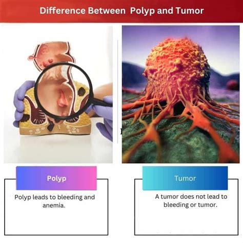 Polyp Vs Tumor Difference And Comparison