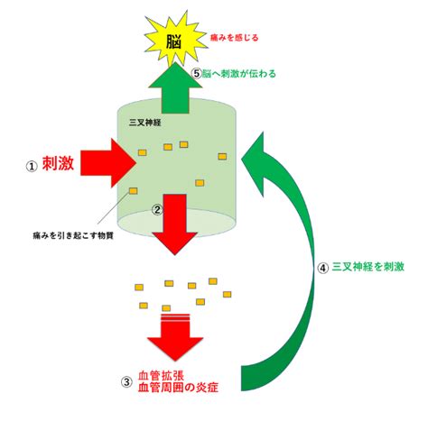 片頭痛の原因と治療薬ｰトリプタン系薬が症状を和らげる わかりやすい薬の解説