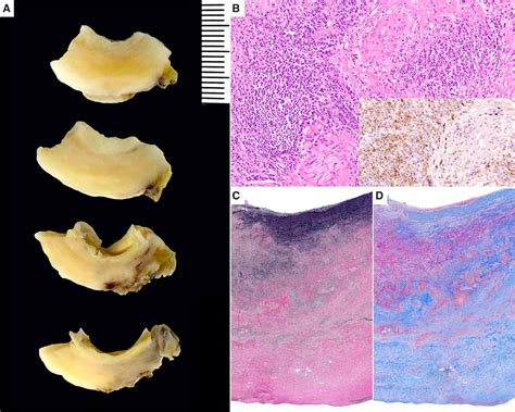 Unexpected Aortitis Mimicking An Ascending Aorta Intramural Hematoma In
