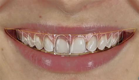 Explore The Process Of Designing Smiles Using Digital Smile Design Technology