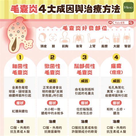 毛囊炎反覆好不了？毛囊炎好發部位與4種成因與治療方法 Heho健康