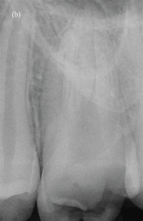 A Preoperative Orthoradial X Ray B Preoperative Distal Angulated