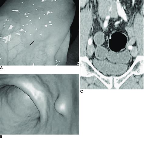 Images In A 56 Year Old Man With 5 Mm Polyp In Sigmoid Colon A
