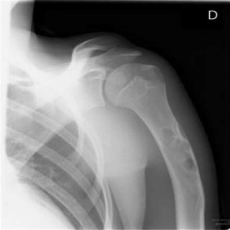 Bone X Rays Object Detection Dataset And Pre Trained Model By Pracainzynierska
