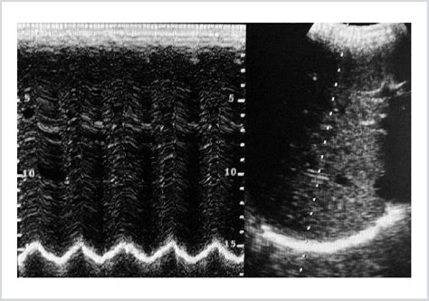 Diaphragm Excursion On The Right M Mode Download Scientific Diagram