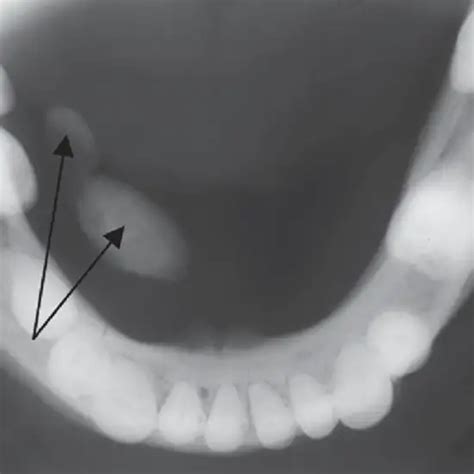 X Ray Right Submandibular Occlusal View Test Price In Delhi Ganesh