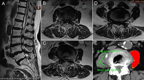Imaging Data Of A 79 Year Old Woman With Symptomatic Multilevel Lumbar