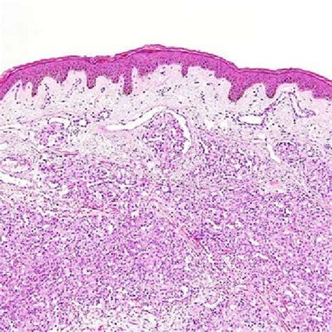 A Glomeruloid Hemangioma The Dermis Features A Proliferation Of