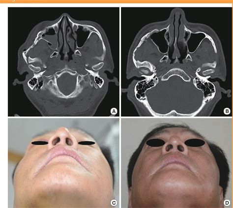 Zygomatic Abscess Symptoms At Alex Wright Blog