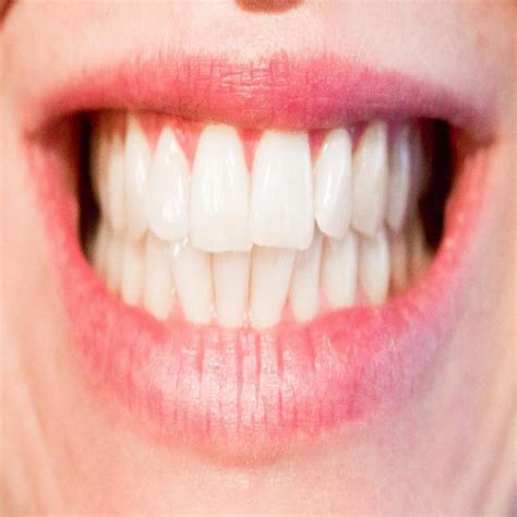 Caries Classification Object Detection Dataset By Carident