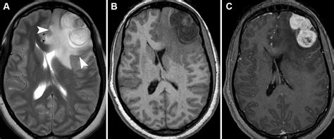 A Radiologists Guide To The 2021 Who Central Nervous System Tumor Classification Part 2—newly