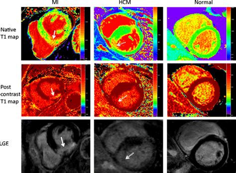 Myocardial T1 And Extracellular Volume Ecv Mapping Na