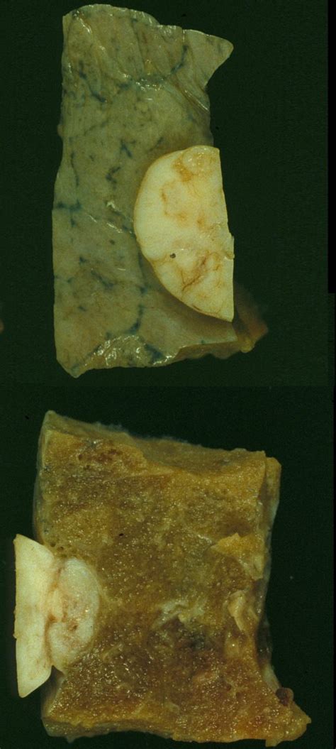 000 Solitary Fibrous Tumor Sft Benign Fibrous Mesothelioma Lungs