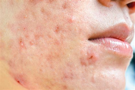 Early Signs Of Liver Damage That You Shouldn T Ignore