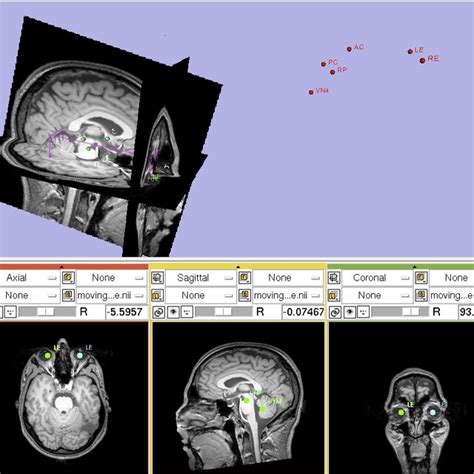Fixed And Moving Landmarks For 3d Affine Transformation With 6 Paired
