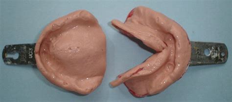 What Is Primary Impression In Dental At Philip Mayers Blog