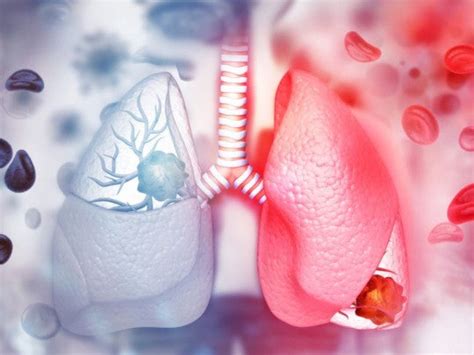La Fda Aprobó Un Nuevo Medicamento Para Combatir El Cáncer De Pulmón
