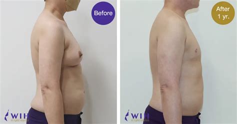 Female To Male Mastectomy Wih International Hospital