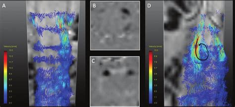Coronal 4d Phase Contrast Csf Flow Image A And Axial 2d Download