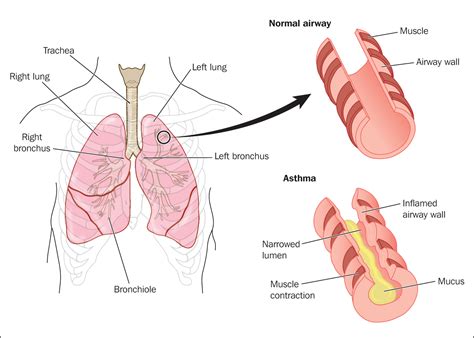 Asthma Lungs Compared To Normal Lungs