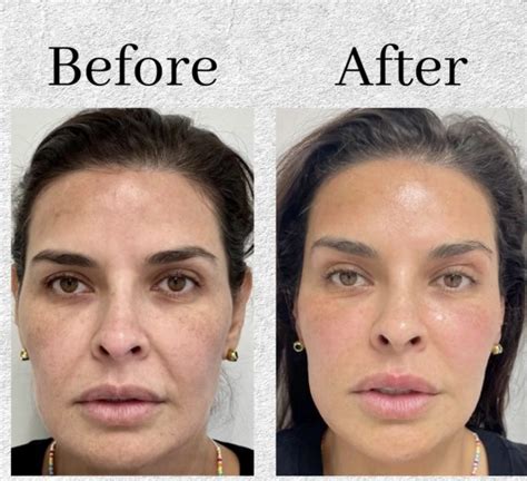 Three Melasma Fotona Laser Treatments Ph