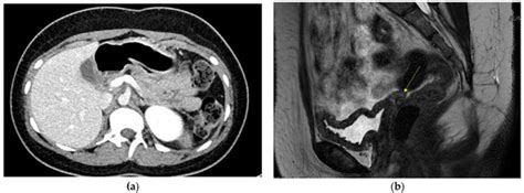A Case Of Chromosome 17q12 Deletion Syndrome With Type 2 Mayer