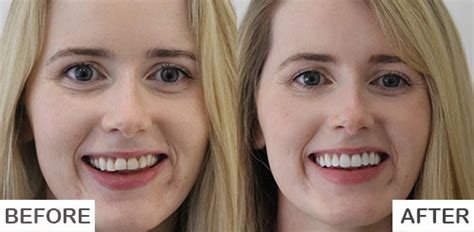 The Best Smile Makeover With Porcelain Veneers