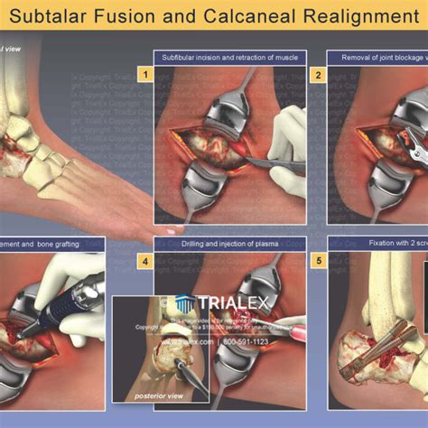 Medical Legal Exhibits Legal Animations And Trial Graphics Tria