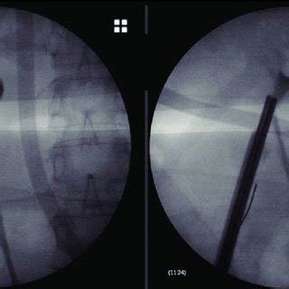 Exploration Of Upper Calyx Through Inferior Calyx Approach In The Prone