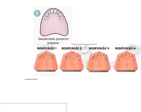 Atualizado 00 Classificações Kennedy Applegate E Rumple Prótese
