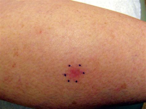 Erythema Induratum Histology