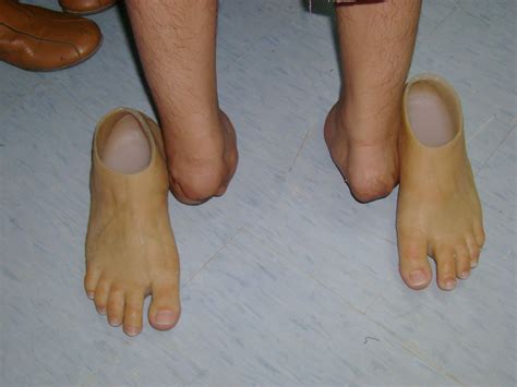 Prosthetic Foot Types Design Talk