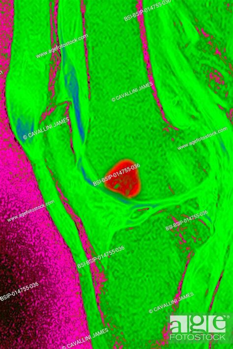 Osseous Edema On The Knee Sub Cortical Lesion Of The Condyle Seen On A Sagittal Section MRI