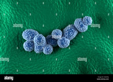 Prostate Cancer Cells In The Prostatic Glandular Epithelium Top View
