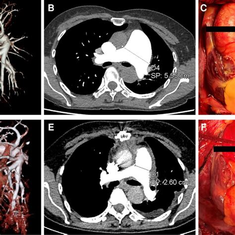 Preoperative And Postoperative Data Ab Are Preoperative Pulmonary Download Scientific