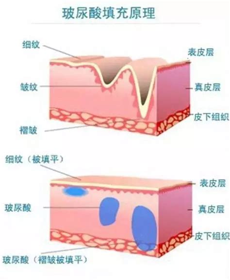 玻尿酸作用是什么，那医院注射玻尿酸效果好上海美莱整形医院