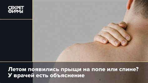 Почему летом на попе появляются прыщи Рассказывает врач Новости — Секрет фирмы