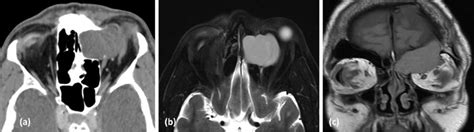 An A Axial View Ct Scan Showing A Left Frontoethmoidal Mucocele