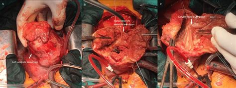 Surgical Reconstruction Of The Left Ventricular Aneurysm A Surgical