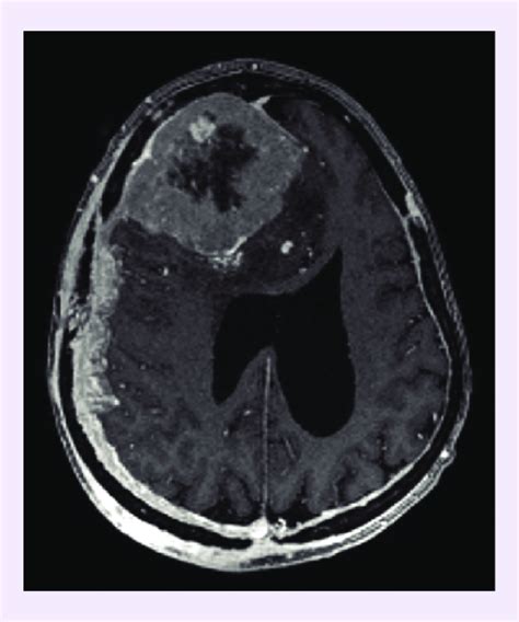 Axial T1 Contrast Enhanced Mri An Axial T1 Contrast Enhanced Mri Image