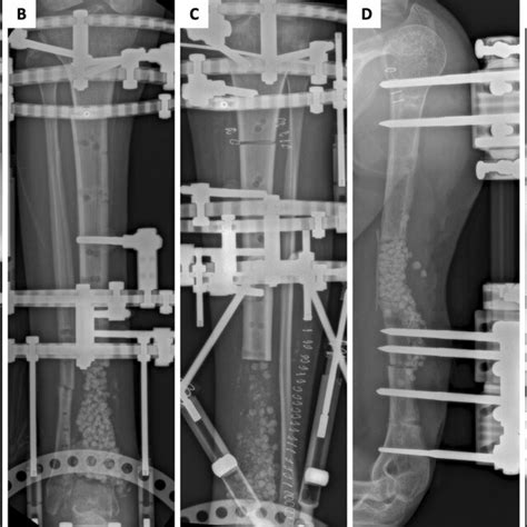 Distal Tibia Osteomyelitis In Patient 1 Ac Ap Radiographs Of The Download Scientific Diagram