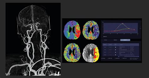 Somatom Xcite 지멘스 헬시니어스㈜