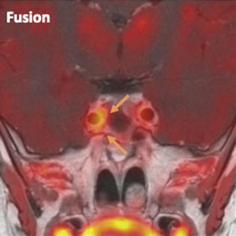 18F FET PET MR For The Detection Of Pituitary Microadenoma