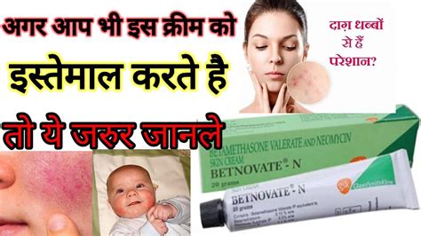 Betnovate N Skin Cream Review In HindiBetnovate N Skin Cream Used And