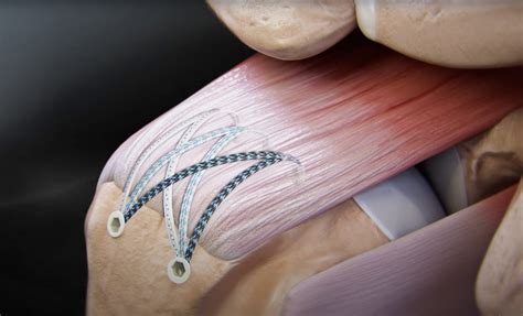 Rotator Cuff Tear Repair St Georges Shoulder Unit