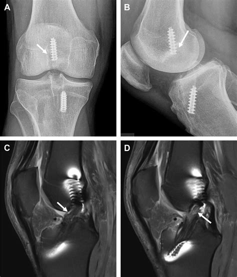 Postoperative Magnetic Resonance Imaging Of The Knee Ligaments