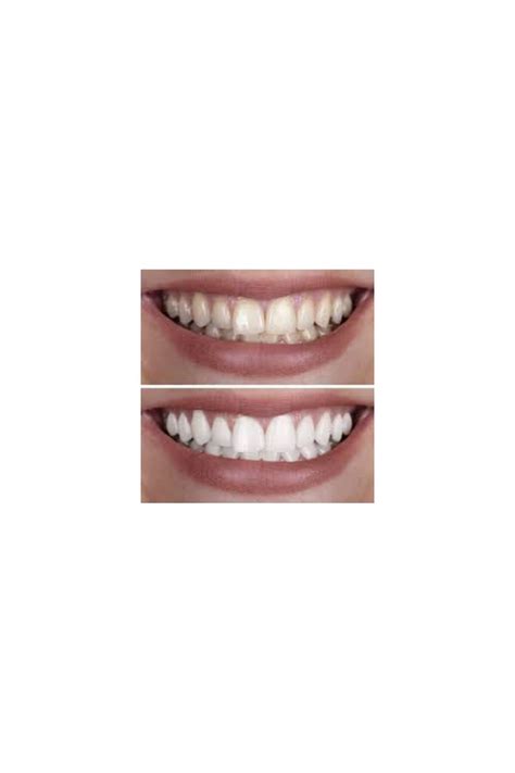 Qartz Quartz Prophylaxis Paste Cherry Tart With Cherry 340g Teeth